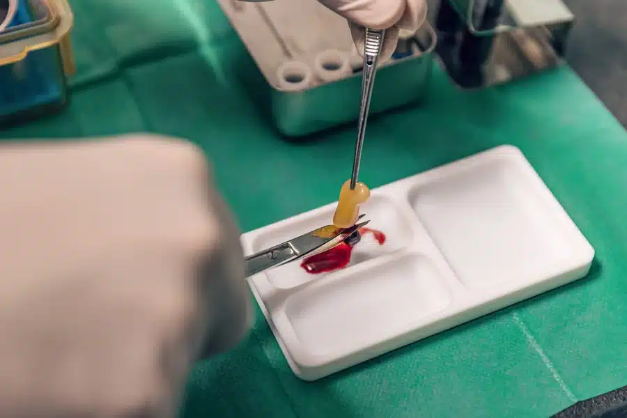 Dental Implant By (PRF) Platelet-Rich Fibrin Technique in Istanbul